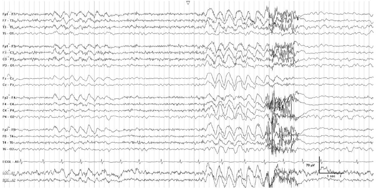 Generalized Encephalopathy | Thoracic Key