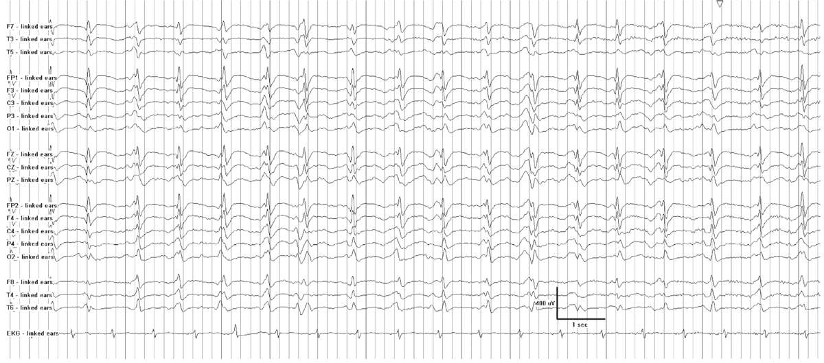 Generalized Encephalopathy | Thoracic Key