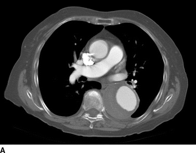 Management of Left Subclavian Artery with TEVAR | Thoracic Key