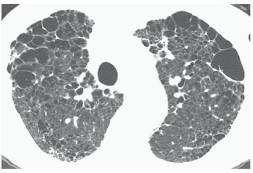 Emphysema and Chronic Obstructive Pulmonary Disease | Thoracic Key
