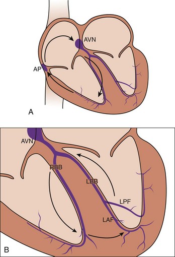 Mechanisms of Re-entrant Arrhythmias | Thoracic Key