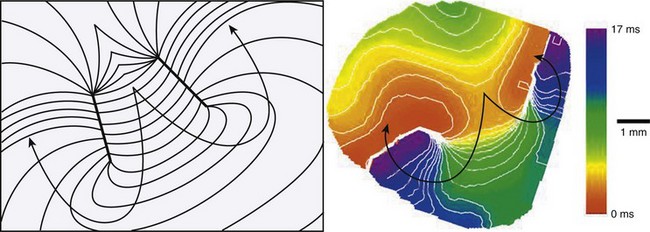 Mechanisms of Re-entrant Arrhythmias | Thoracic Key