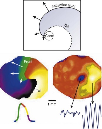 Mechanisms of Re-entrant Arrhythmias | Thoracic Key