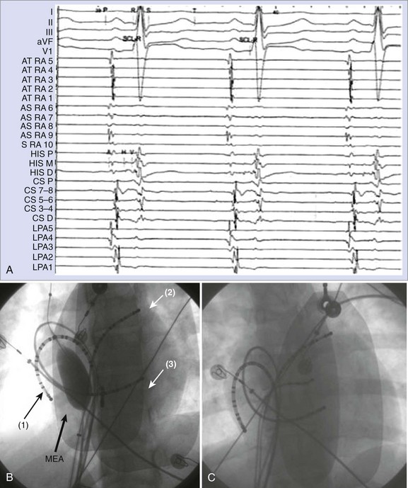 Electrophysiological Evaluation of Atrial Fibrillation | Thoracic Key