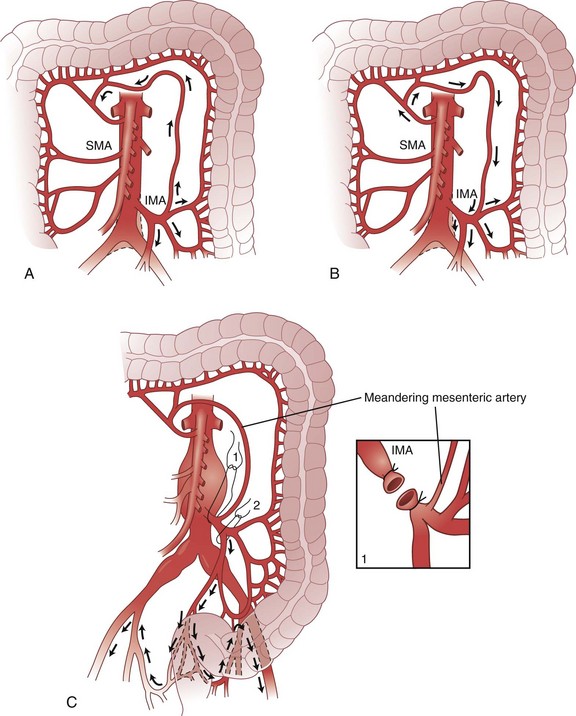 Colon and Rectum | Thoracic Key