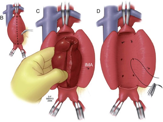 The Aorta | Thoracic Key