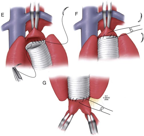 The Aorta | Thoracic Key