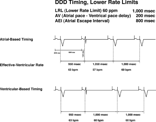 Dual-chamber Pacing: Special Considerations | Thoracic Key