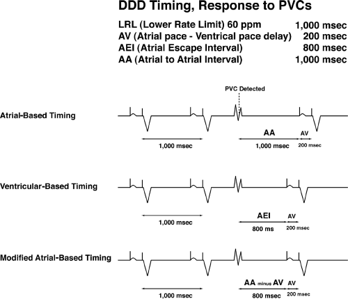 Dual-chamber Pacing: Special Considerations | Thoracic Key