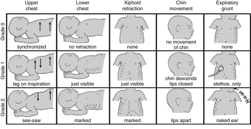 Neonatal and Pediatric Mechanical Ventilation | Thoracic Key