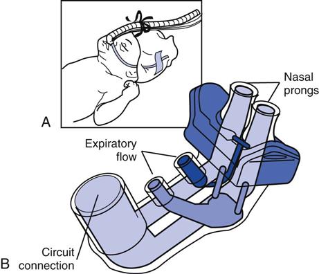 Neonatal and Pediatric Mechanical Ventilation | Thoracic Key