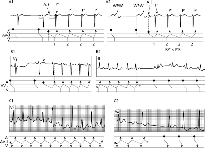 11: ECG Patterns of Supraventricular Arrhythmias | Thoracic Key