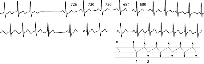 11: ECG Patterns of Supraventricular Arrhythmias | Thoracic Key