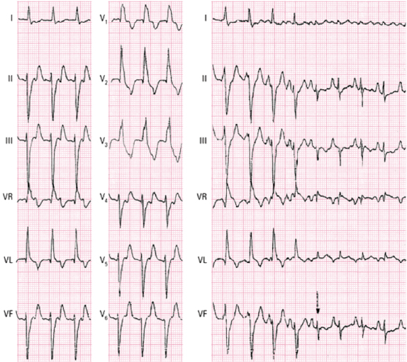 12: ECG Patterns of Ventricular Arrhythmias | Thoracic Key