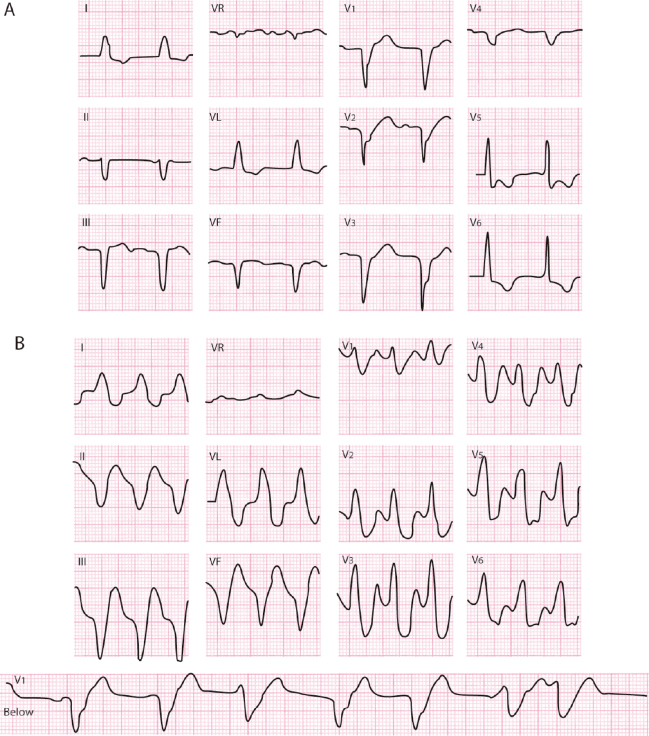 12: ECG Patterns of Ventricular Arrhythmias | Thoracic Key
