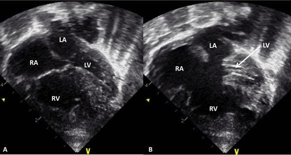 Hypoplastic Left Heart Syndrome | Thoracic Key