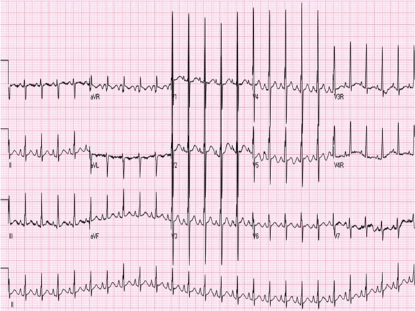 Hypoplastic Left Heart Syndrome | Thoracic Key