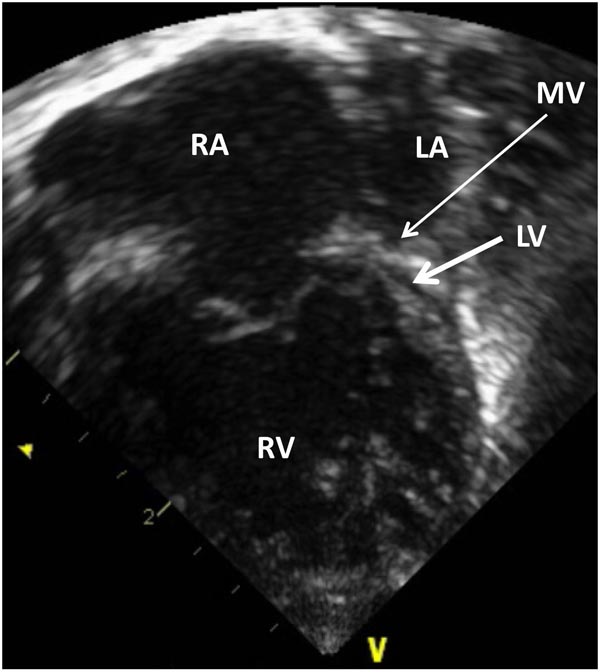 Hypoplastic Left Heart Syndrome | Thoracic Key