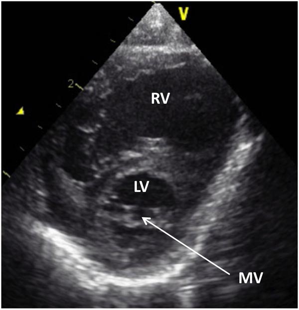 Hypoplastic Left Heart Syndrome | Thoracic Key