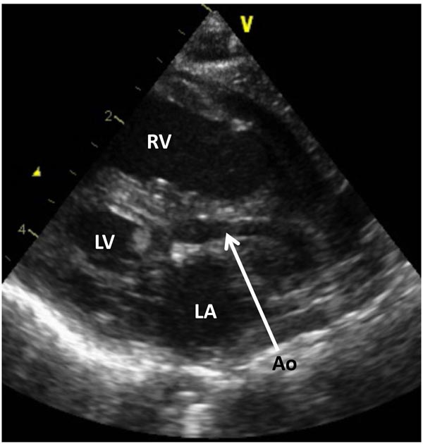 Hypoplastic Left Heart Syndrome | Thoracic Key