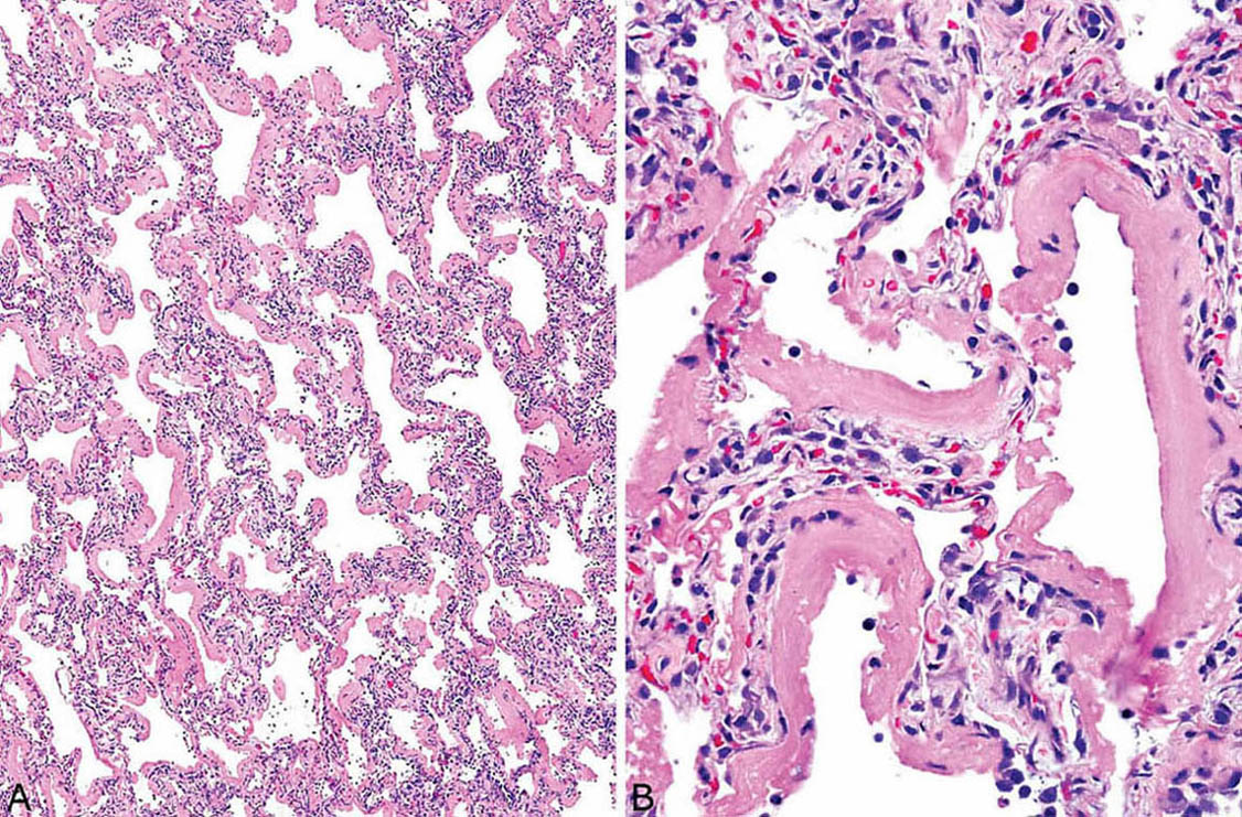 Diffuse Alveolar Damage, Acute Interstitial Pneumonia | Thoracic Key