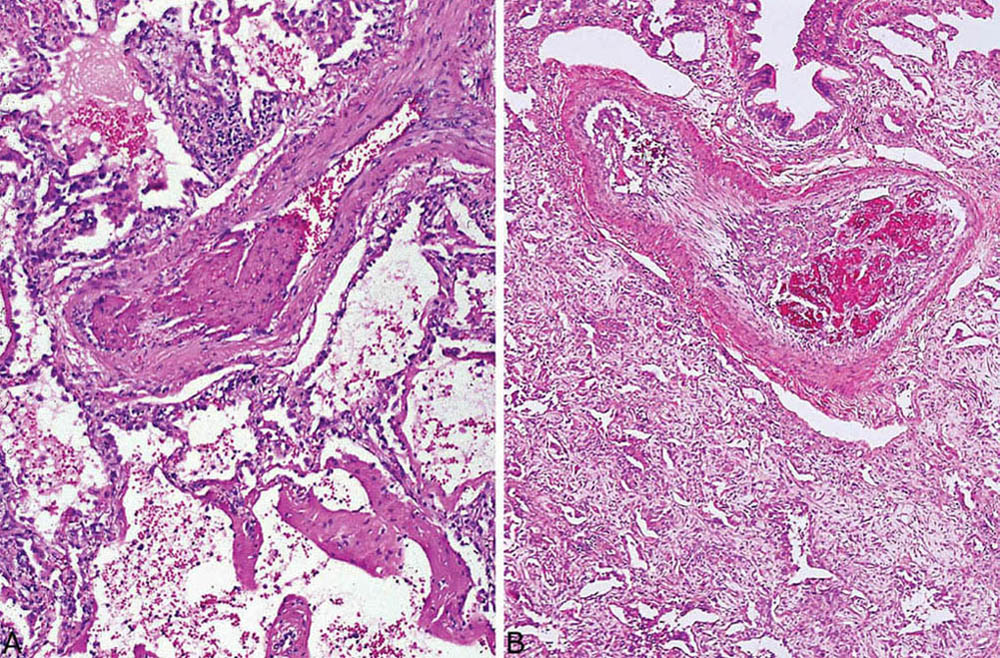 Diffuse Alveolar Damage, Acute Interstitial Pneumonia | Thoracic Key
