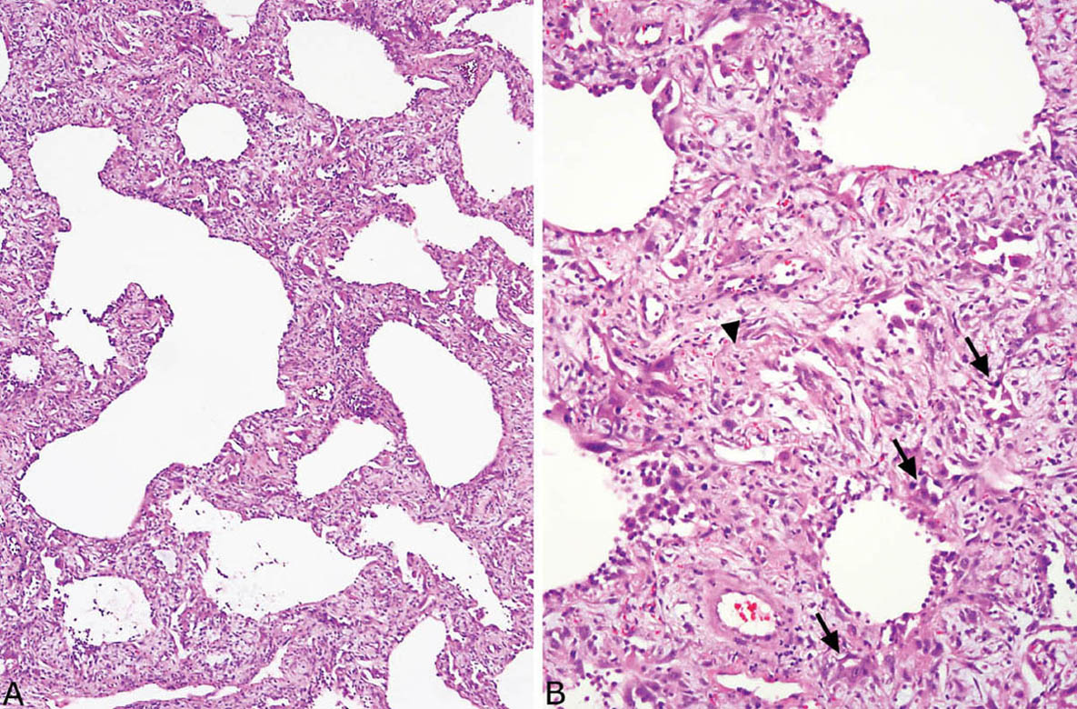 Diffuse Alveolar Damage, Acute Interstitial Pneumonia | Thoracic Key