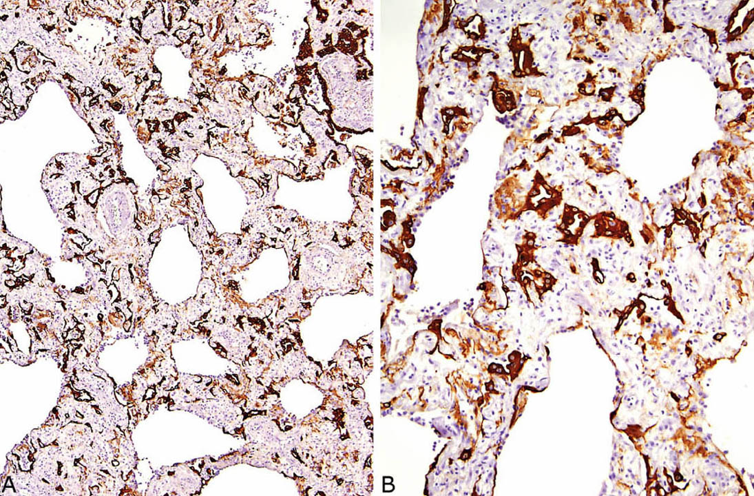 Diffuse Alveolar Damage, Acute Interstitial Pneumonia | Thoracic Key