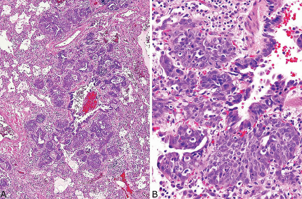 Diffuse Alveolar Damage, Acute Interstitial Pneumonia | Thoracic Key