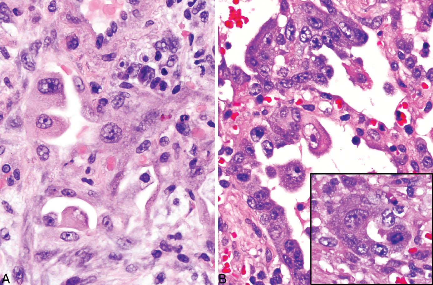 Diffuse Alveolar Damage, Acute Interstitial Pneumonia | Thoracic Key