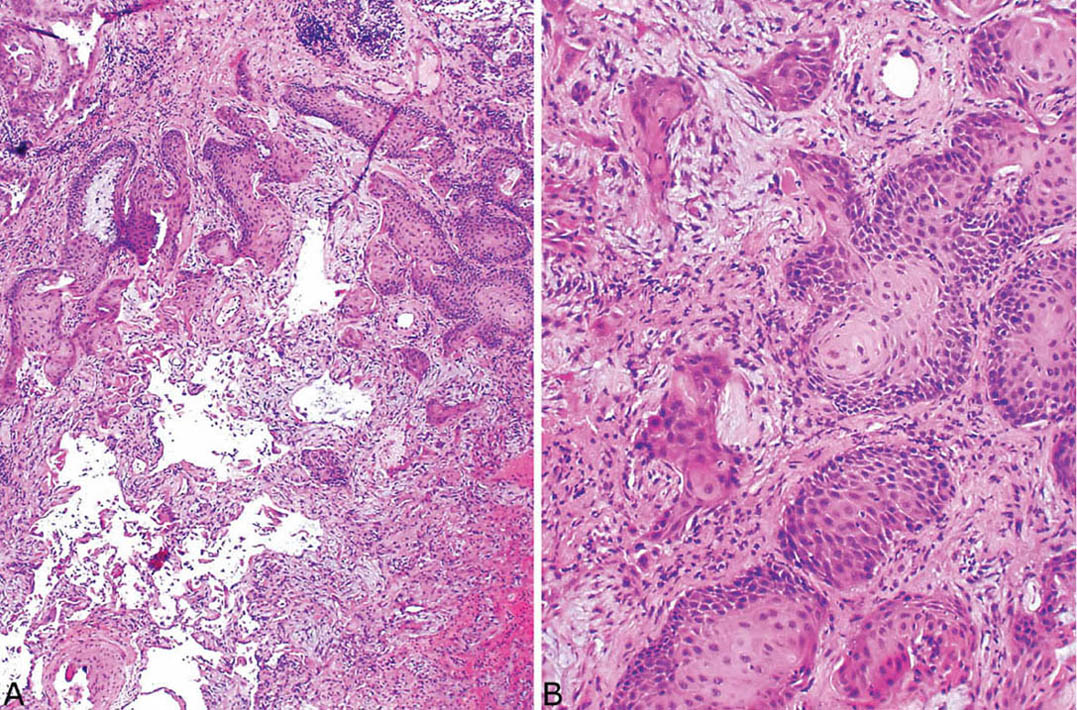 Diffuse Alveolar Damage, Acute Interstitial Pneumonia | Thoracic Key