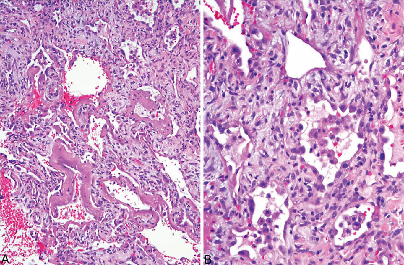 Diffuse Alveolar Damage, Acute Interstitial Pneumonia | Thoracic Key