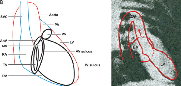 Left and Right Ventriculography, Aortography, and Pulmonary Angiography ...