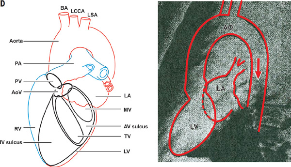 Left and Right Ventriculography, Aortography, and Pulmonary Angiography ...