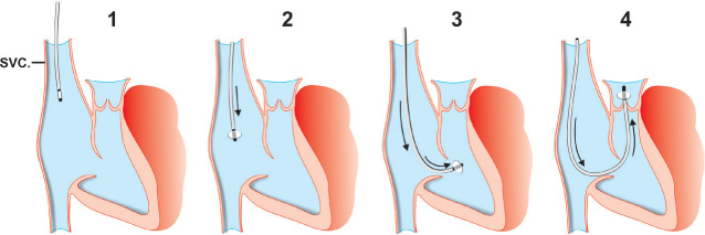 Right Heart Catheterization | Thoracic Key