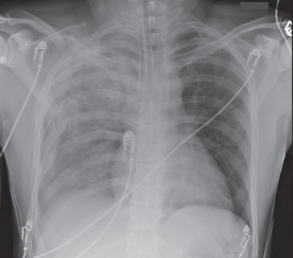 Blunt and Penetrating Injuries | Thoracic Key