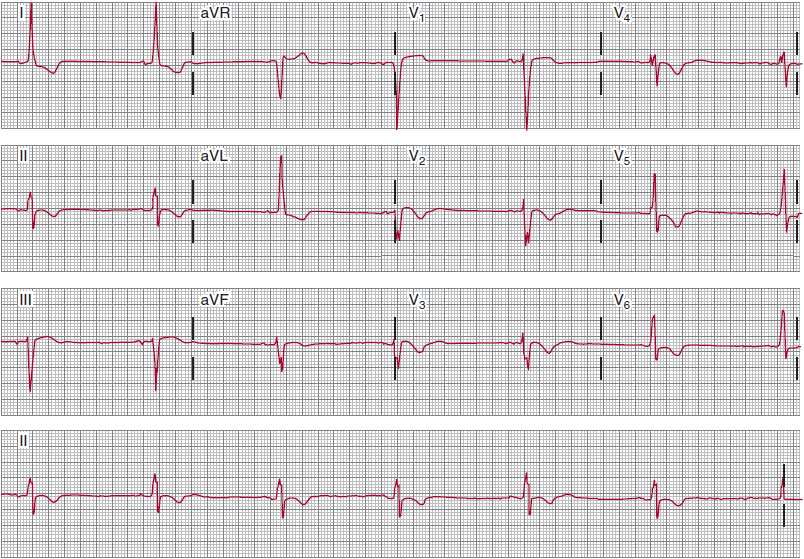 Conduction Disorders & Cardiac Pacing | Thoracic Key