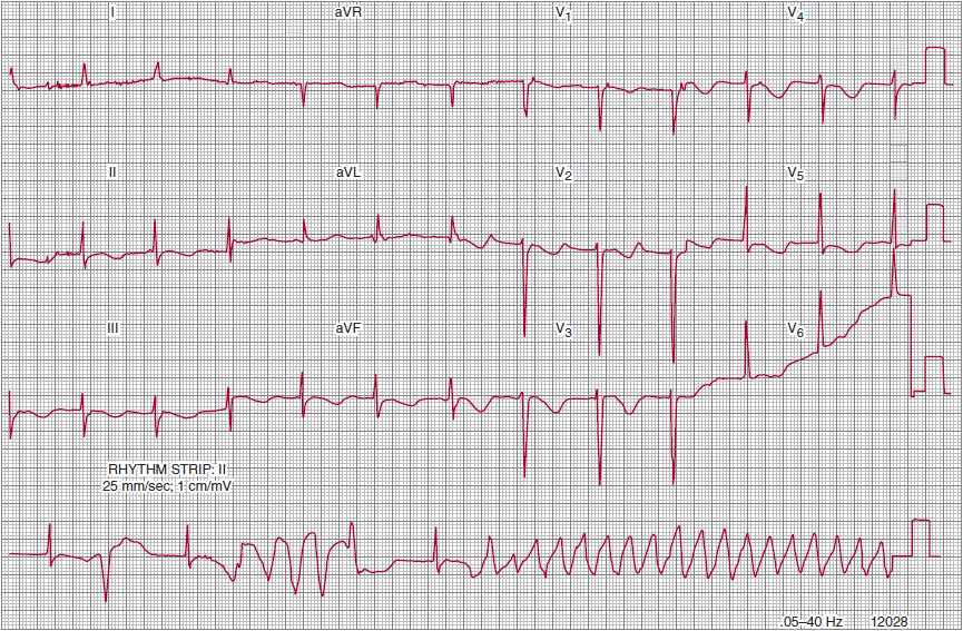 Conduction Disorders & Cardiac Pacing | Thoracic Key