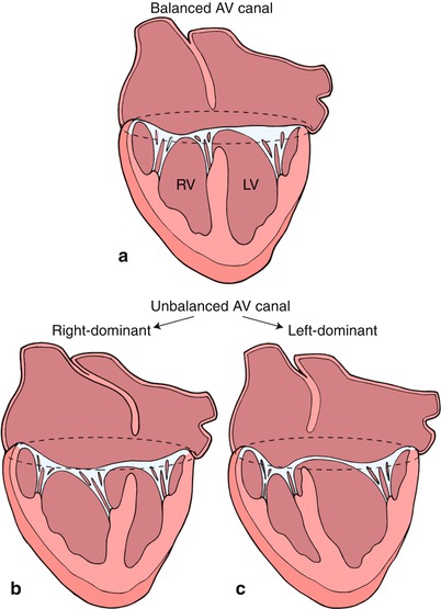 Atrioventricular Septal Defects and Atrioventricular Valve Anomalies ...