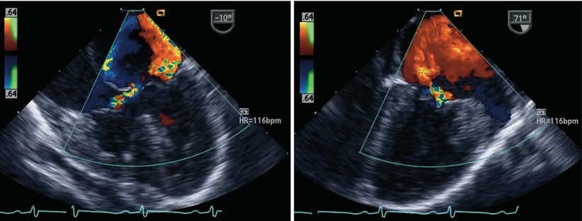 Atrioventricular Septal Defects and Atrioventricular Valve Anomalies ...