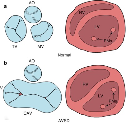 Atrioventricular Septal Defects and Atrioventricular Valve Anomalies ...