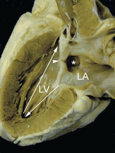 Atrioventricular Septal Defects and Atrioventricular Valve Anomalies ...
