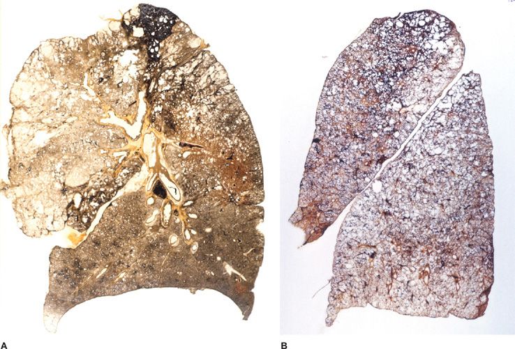 Pathology of Chronic Obstructive Pulmonary Disease: Diagnostic Features ...