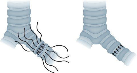 Lung Transplantation | Thoracic Key