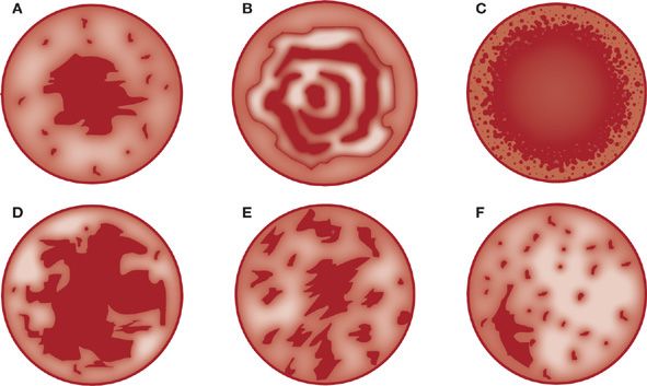 Approach to the Patient with Pulmonary Nodules | Thoracic Key