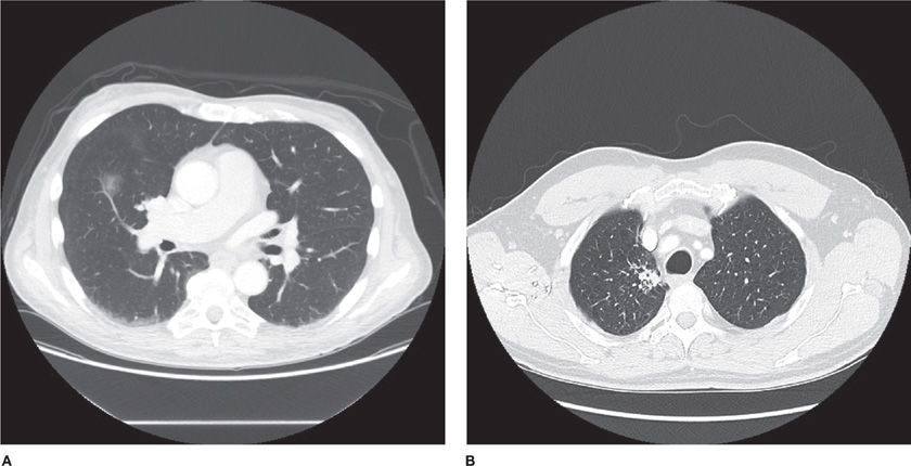 Approach to the Patient with Pulmonary Nodules | Thoracic Key