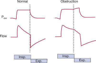 Principles of Mechanical Ventilation | Thoracic Key