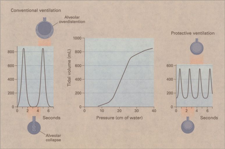 Principles of Mechanical Ventilation | Thoracic Key