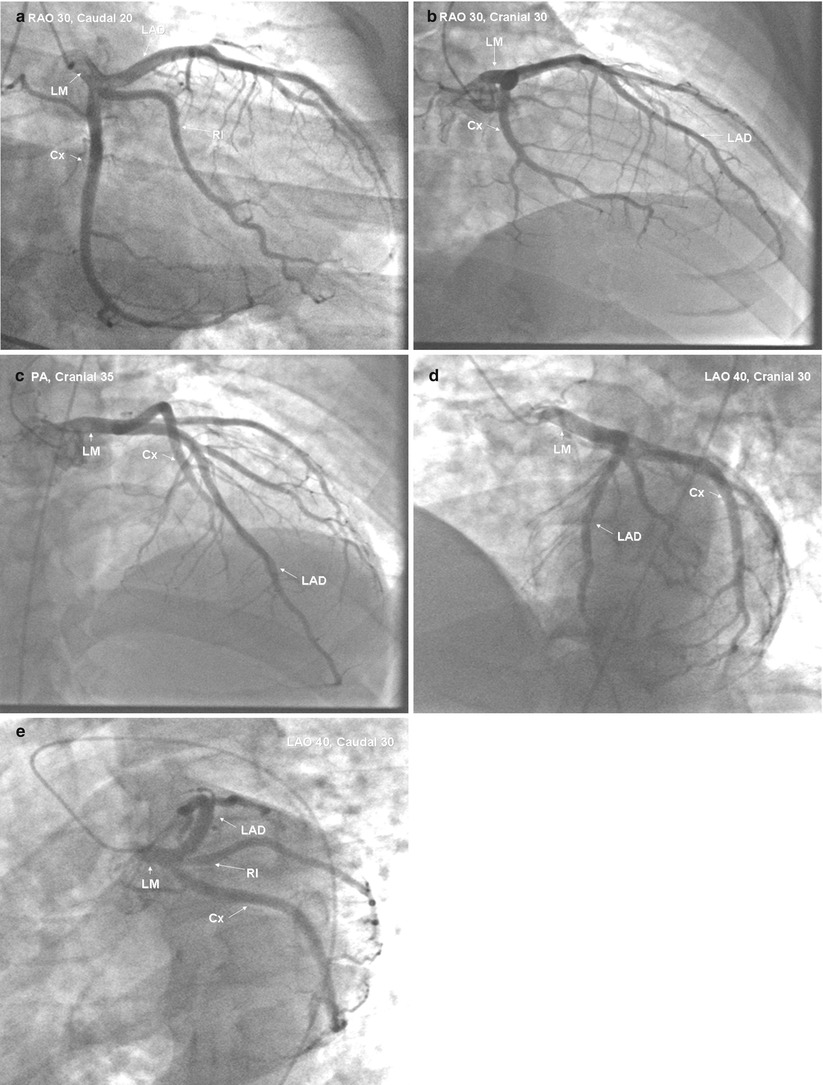 Coronary Angiography | Thoracic Key