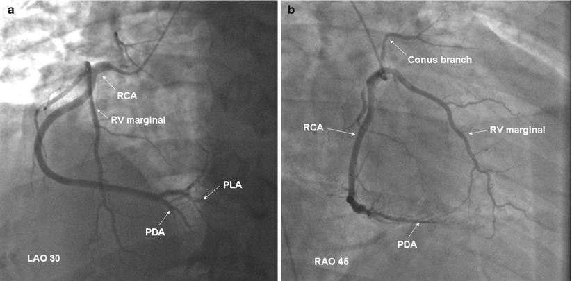 Coronary Angiography | Thoracic Key